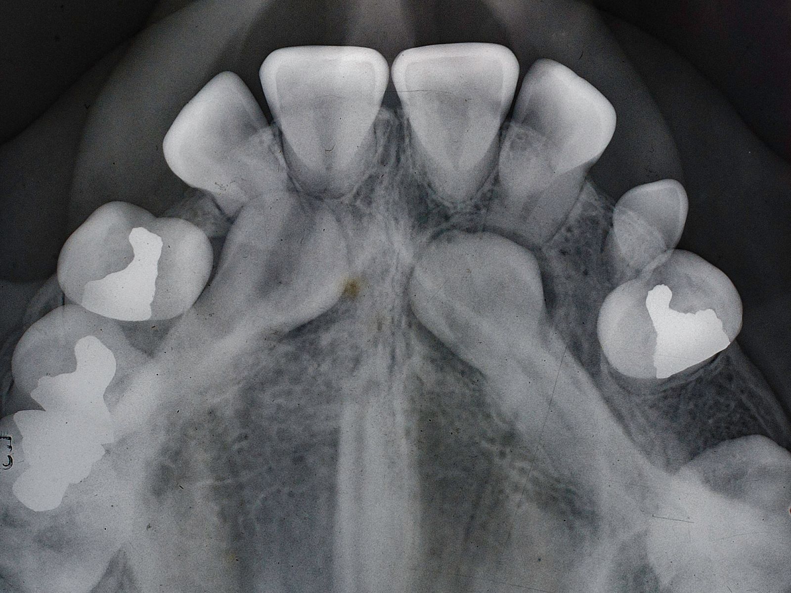 How Solace Oral Surgery Treats Impacted Canines - Solace Implant Center ...